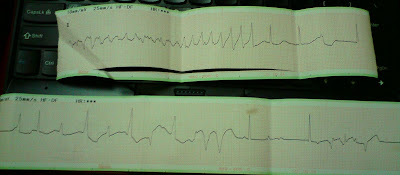 Phoenix: Pause Dependent Torsade de Pointes caused by amiodarone ...