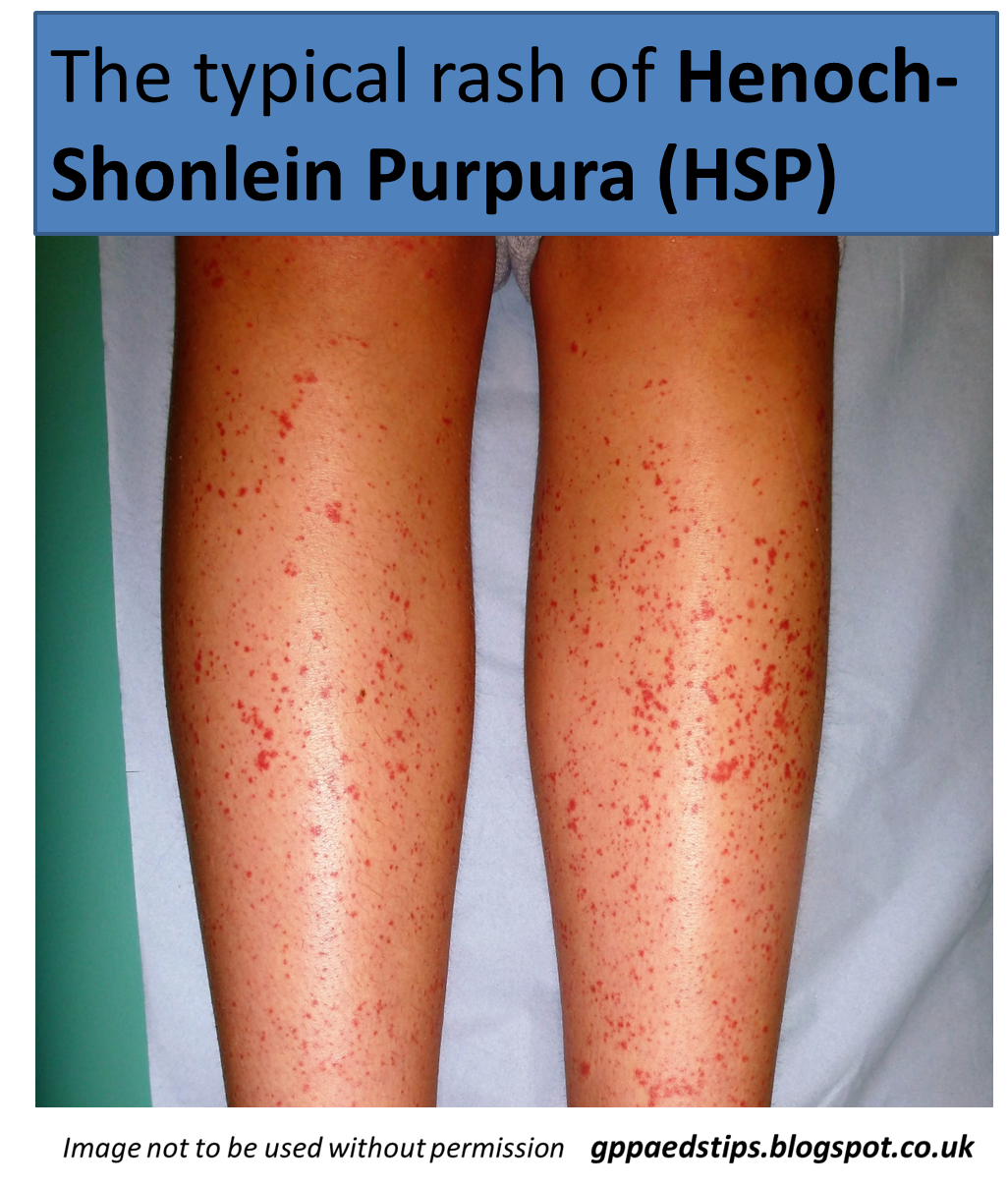 Paediatrics for Primary Care (and anyone else): April 2019