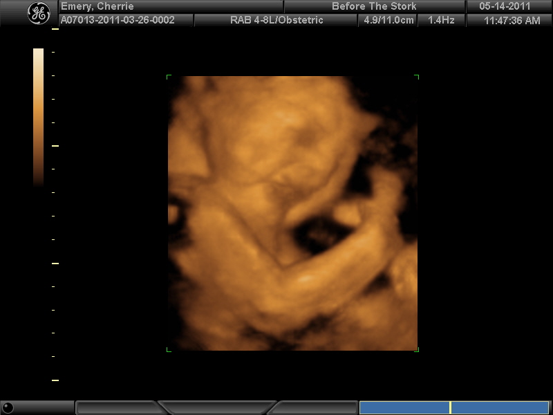 Making mEmerys: 3D/4D Ultrasound-30 Weeks