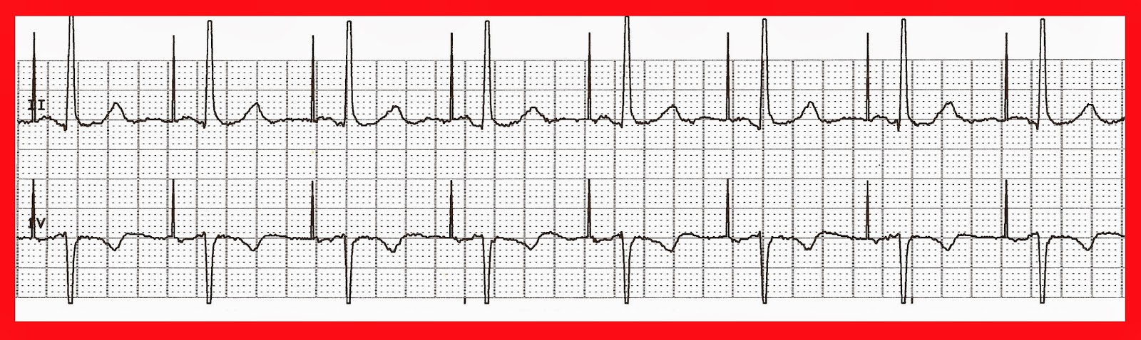 Various Atrial Paced Rhythms