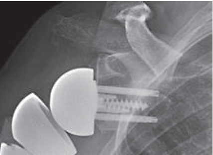 UW Shoulder and Elbow Academy: Reverse total shoulder - safe baseplate ...