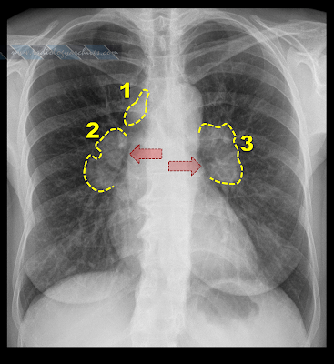 Radiology Archives: Τριάδα του Garland (Σαρκοείδωση)