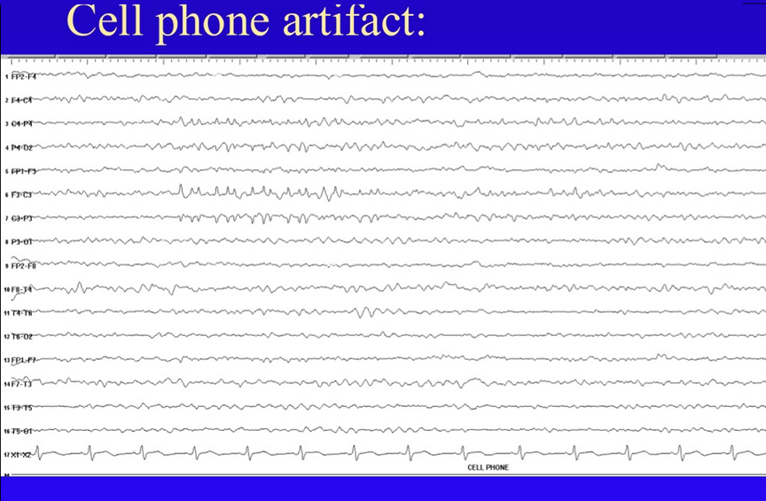 The Neurocritic: Newly Discovered EEG Rhythm Related to Texting, or ...