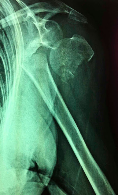 O R T O C R I T I C A: Fractura luxacion de cabeza humeral no reciente ...