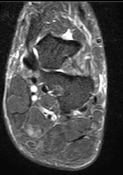 Plantar fasciitis-MRI - Sumer's Radiology Blog
