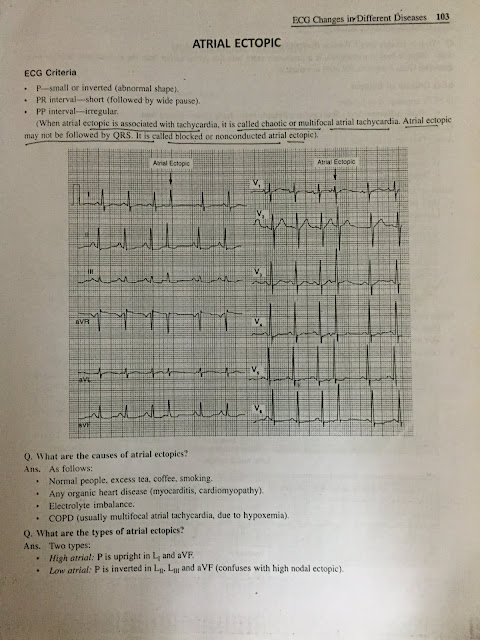 ECG ATRIAL AND VENTRICULAR ECTOPICS