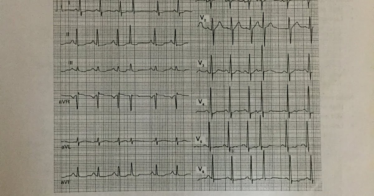 ECG ATRIAL AND VENTRICULAR ECTOPICS