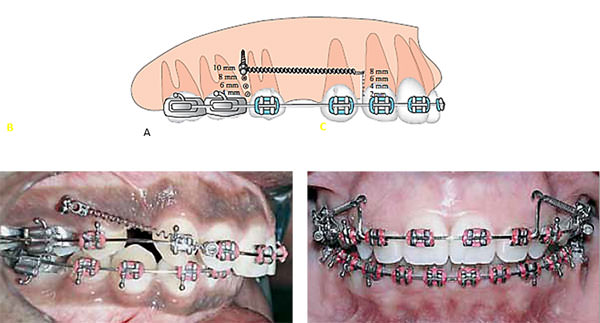 Mario Piattelli Blog: CIERRE DE ESPACIOS EN ORTODONCIA