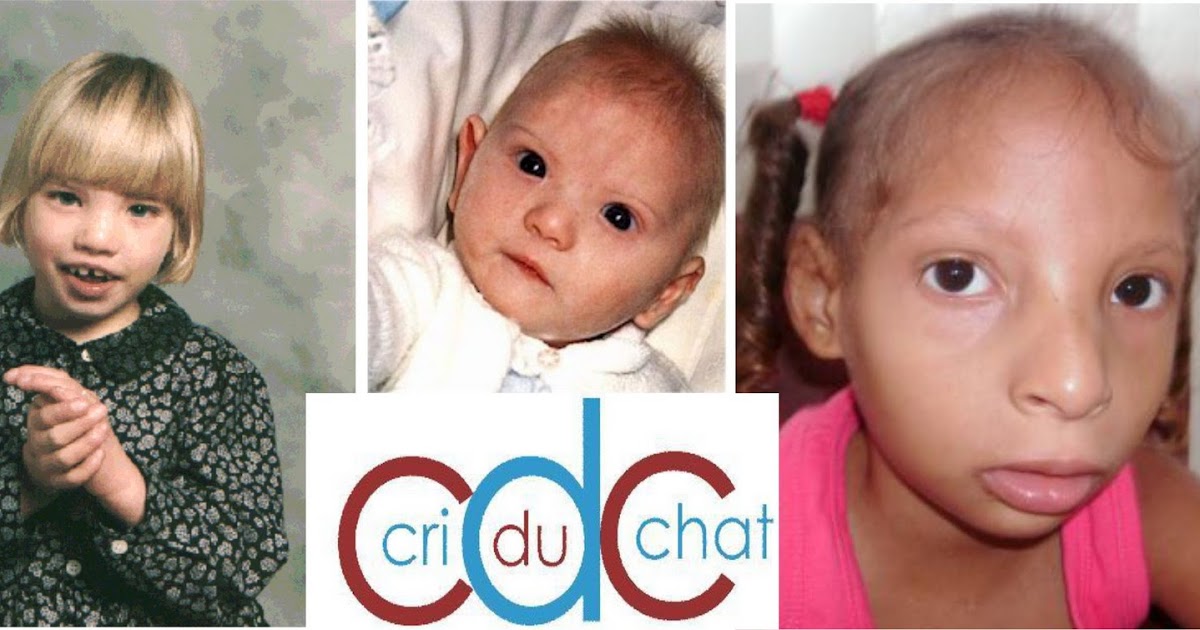 Portfólio de Biologia: Síndrome Cri-Du-Chat