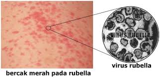 Kenali Penyakit Rubella Penyebab Cacat pada Janin - Biologi Edukasi ...