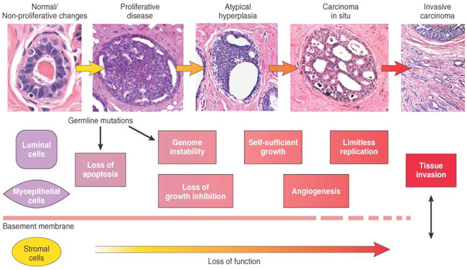 MBBS Medicine (Humanity First): Breast Lesions and Relative Risk of ...