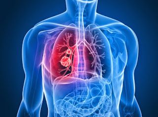 Neumonia causas, sintomas y tratamientos | Salud y Cuidados