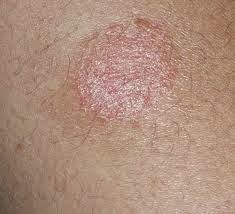 OBAT TRADISIONAL: Obat Herbal Penyakit Eksim | penjual obat herbal