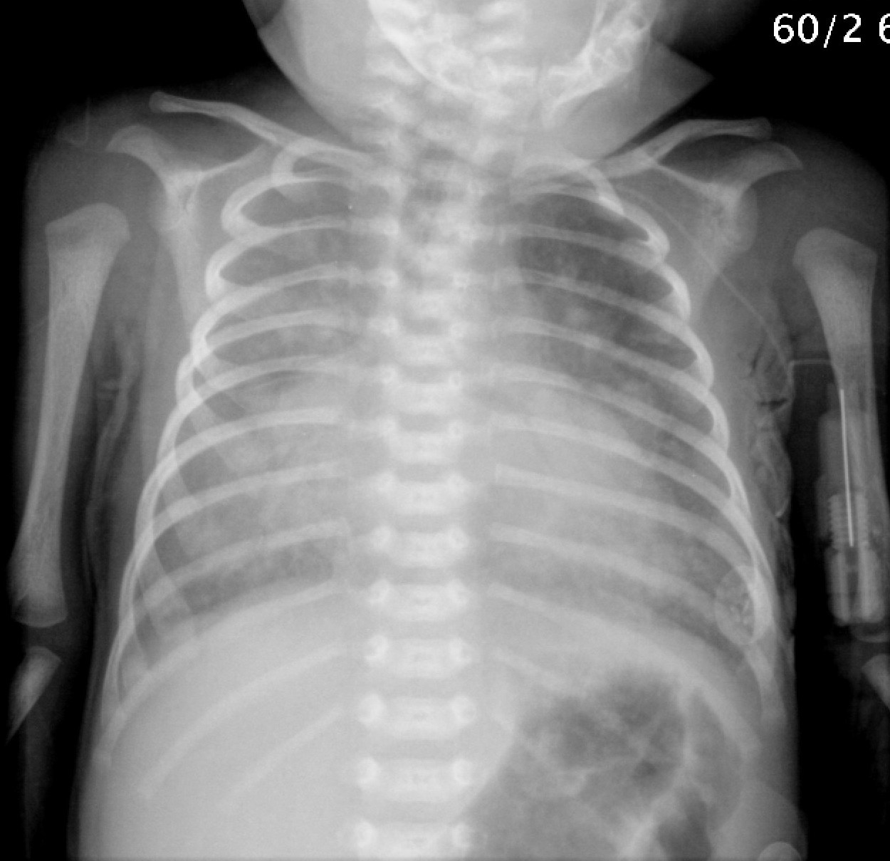 Pedi cardiology: CXR: Obstructed Supracardiac TAPVR