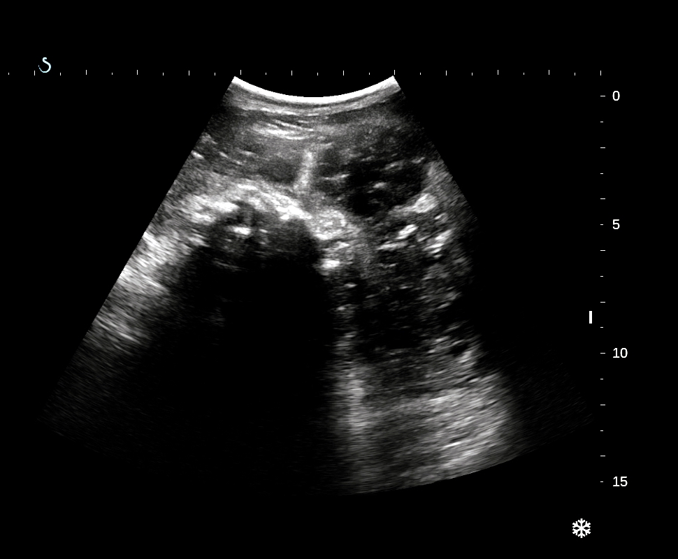 VIETNAMESE MEDIC ULTRASOUND: CASE 344 :LEFT GROIN TUMOR, Dr PHAN THANH ...