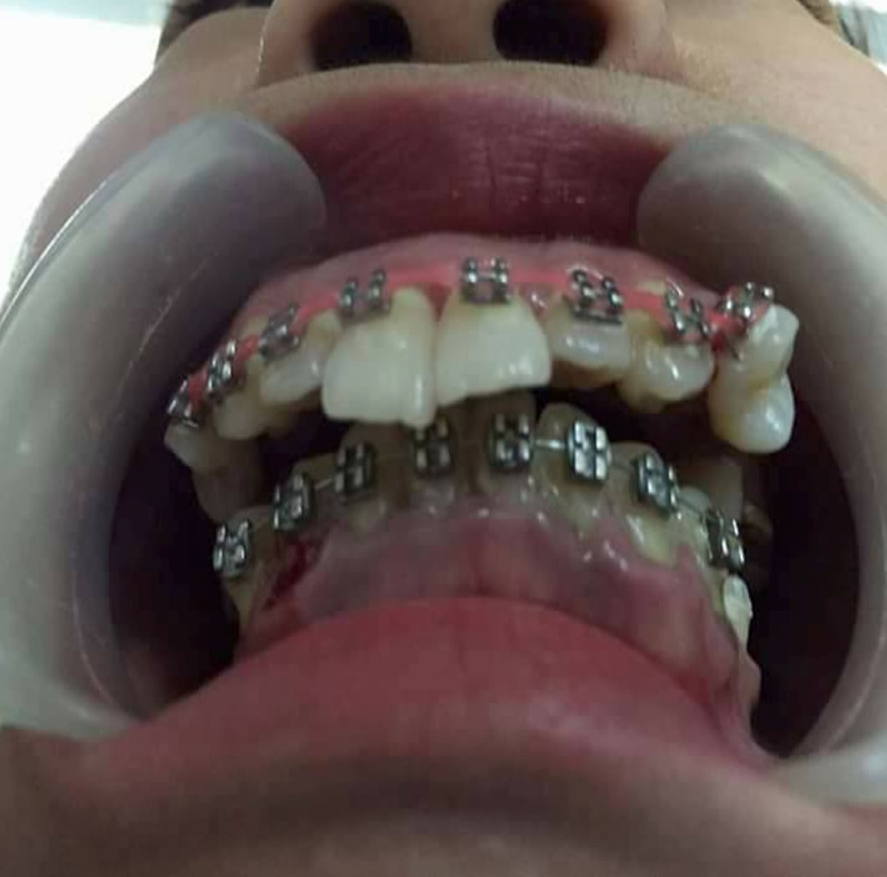 A Woman Whose DIY Dental Braces Terribly Gone Wrong - NEWS INFO PHILIPPINES