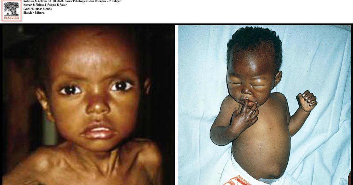 Liga de Pediatria Clínica e Cirúrgica - UFT: ARTIGO "DESNUTRIÇÃO ...