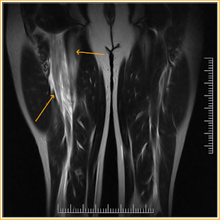 Biceps Femoris Tear-MRI - Sumer's Radiology Blog