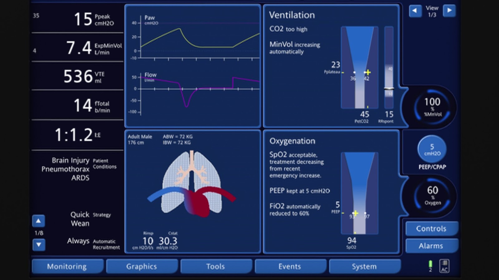 Reflexões sobre Fisioterapia Hospitalar: Ventilação com Suporte ...