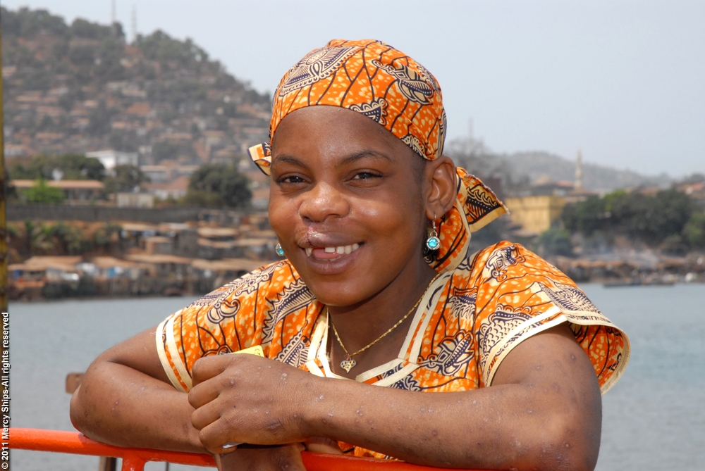 DEBRA BELL MERCY IN WEST AFRICA: SIERRA LEONE-ISATU KONTEH-Cleft Lip