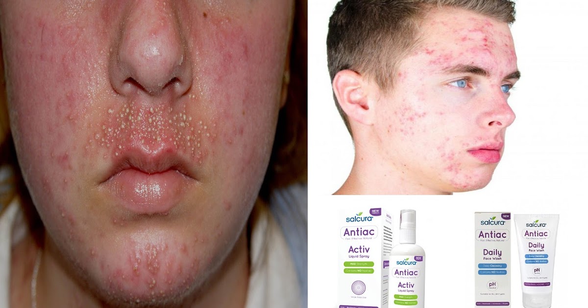 acne skin disease upfront | Skin Acne