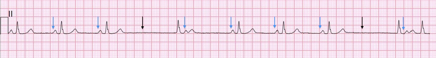 Sick Sinus Syndrome | INA - ECG