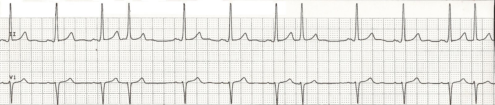 Float Nurse: EKG Rhythm Strips 58