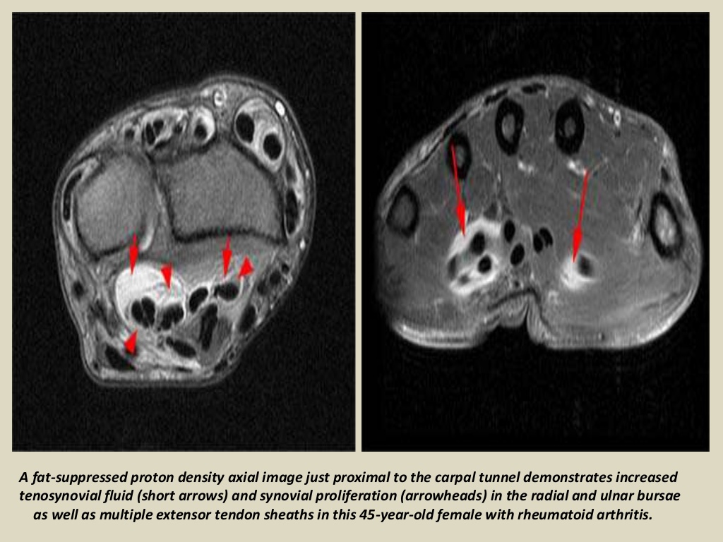 MRI Musculo-Skeletal Section: Bursa of the wrist joint.