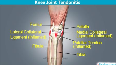 ERGONOMICS GUIDE: CHRONIC KNEE PAIN