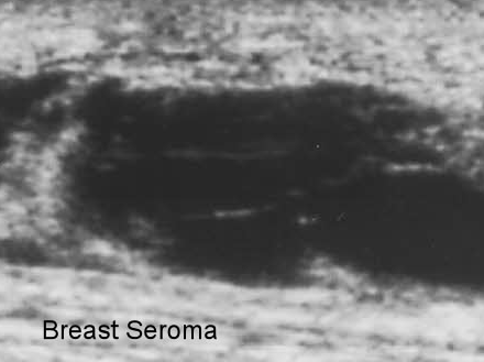 Dr. Lee Breast augmentation Korea: Late seroma after breast implant surgery