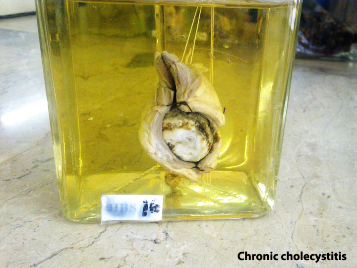 Chronic Cholecystitis Gross