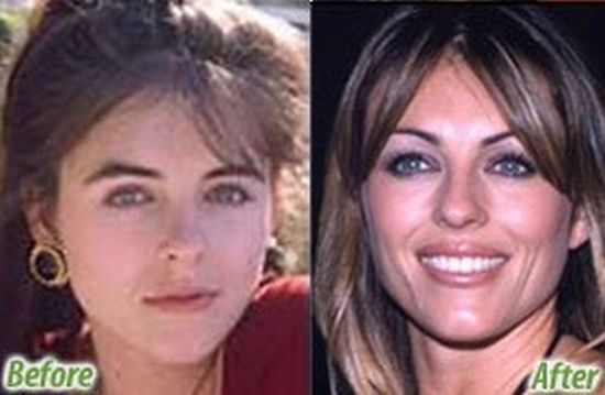 Elizabeth Hurley Plastic Surgery