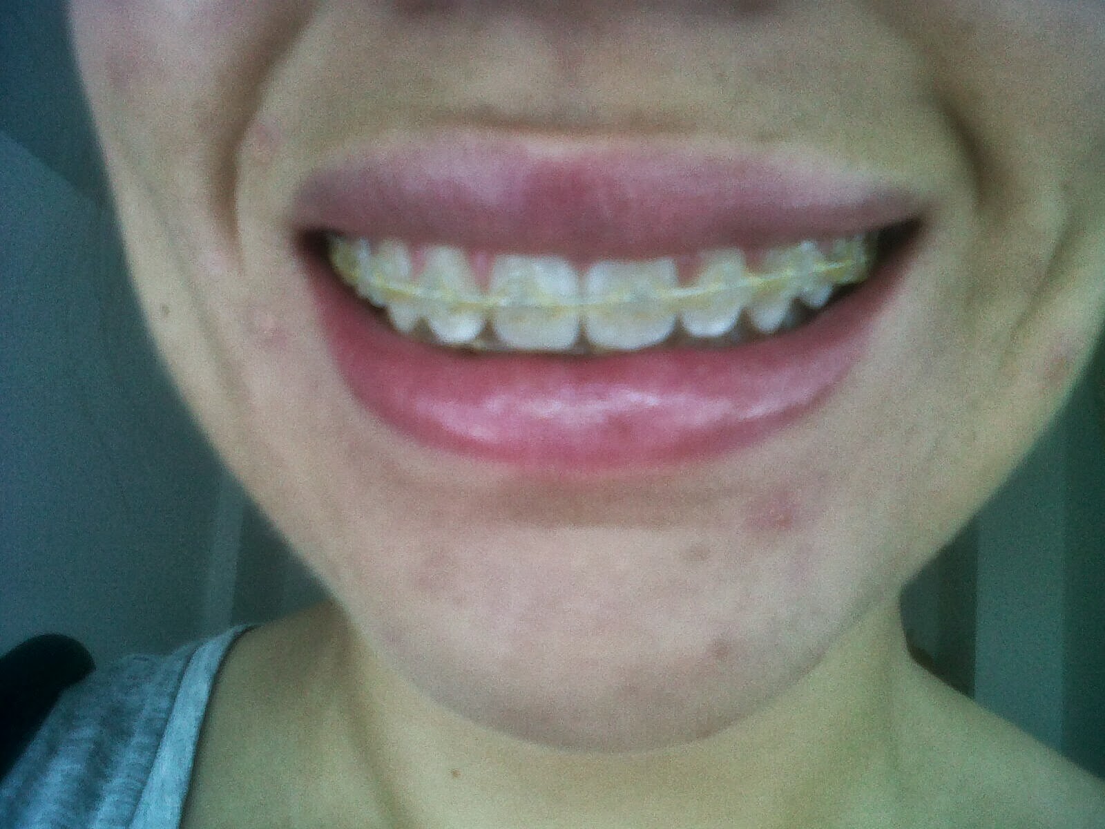 My FastBraces