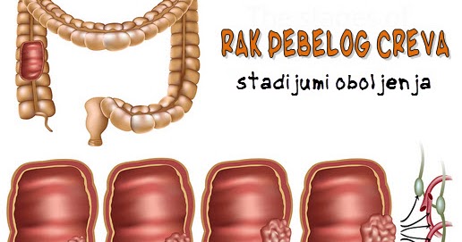 KAKO PREPOZNATI RAK DEBELOG CRIJEVA ~ KOLAČIĆI