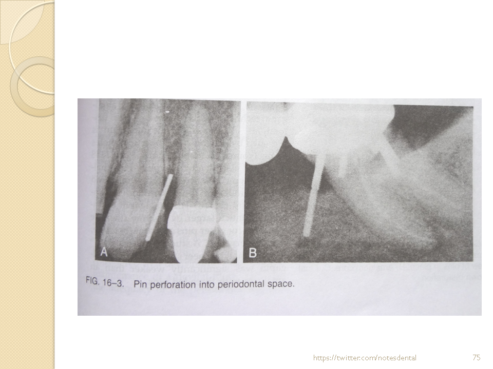 Dental Notes: Pin Retained Restorations NOTES