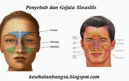 Penyebab dan Gejala Sinusitis - CINTA ILMU KESEHATAN