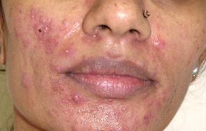 PICTURES OF ACNE TYPES OF ACNE PICTURES ACNE TREATMENTS: Pictures of ...