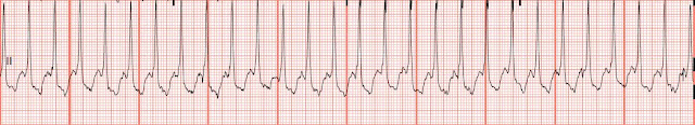 EKG Rhythm Strips: Atrial Rhythms