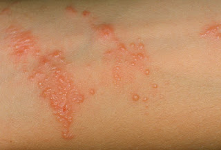 Causes Of Itchy Skin With No Rash What It Can Reveal