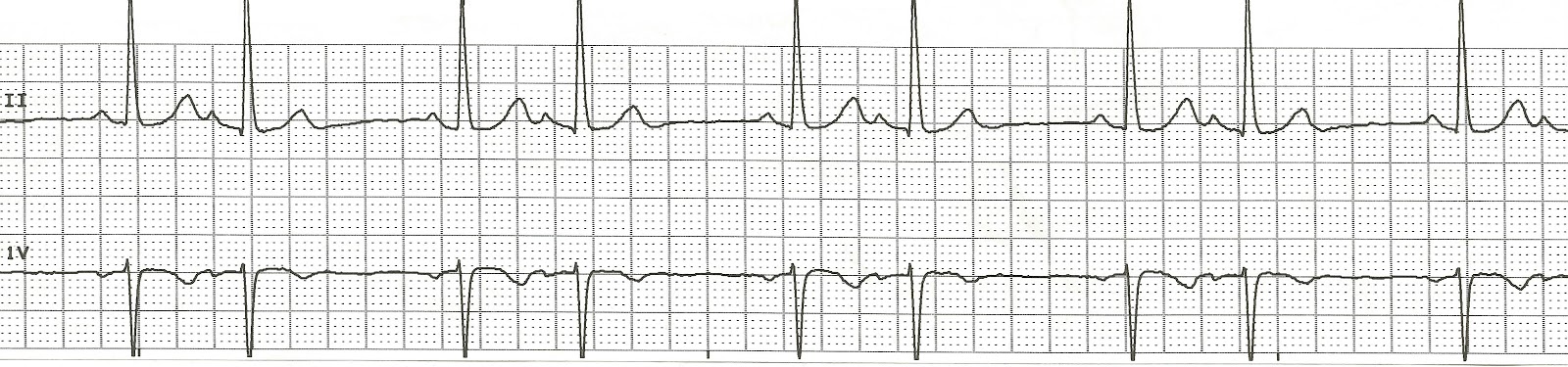 Float Nurse: ECG Rhythm Strip Quiz 79