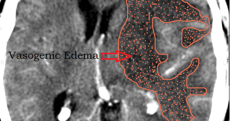 El Baúl Radiológico: EDEMA VASOGÉNICO ¿POR QUÉ? (Vasogenic Edema. Why ...