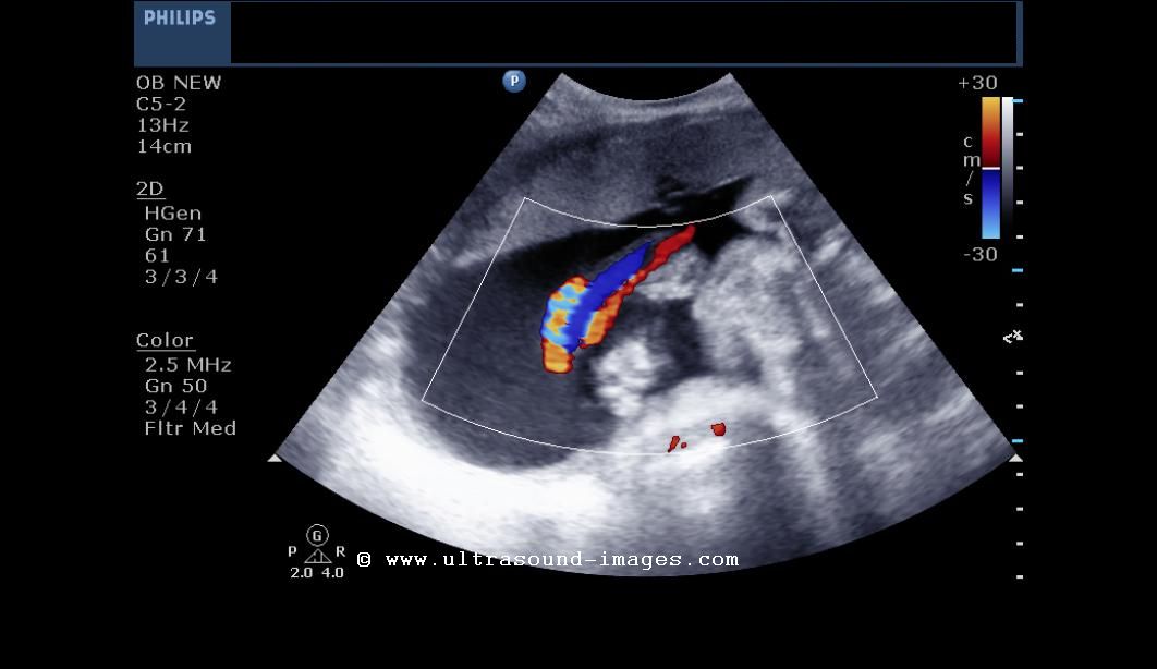 cochinblogs: Pregnancy with fibroid and hypocoiled cord: