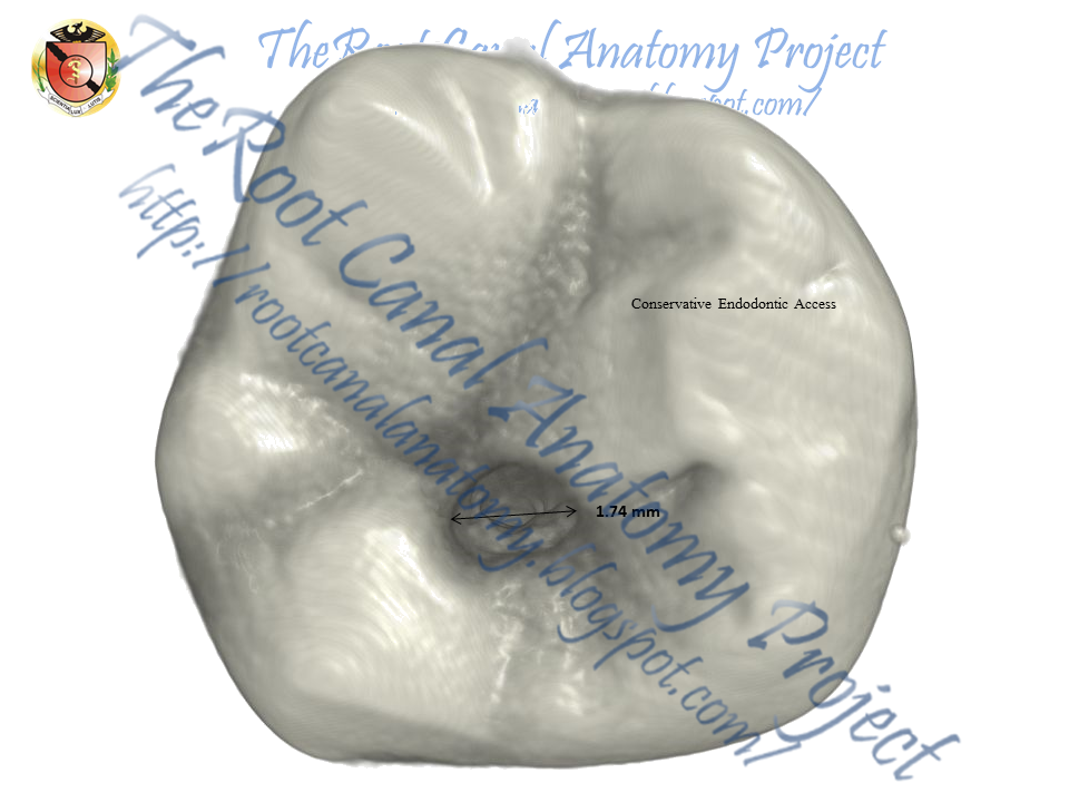 The Root Canal Anatomy Project: Conservative Endodontic Access ...