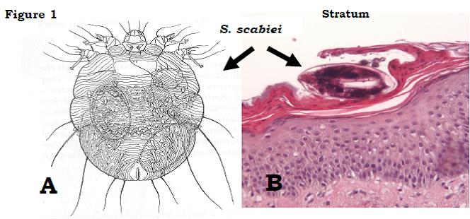 Asuhan Keperawatan Pasien Scabies Lengkap - askep