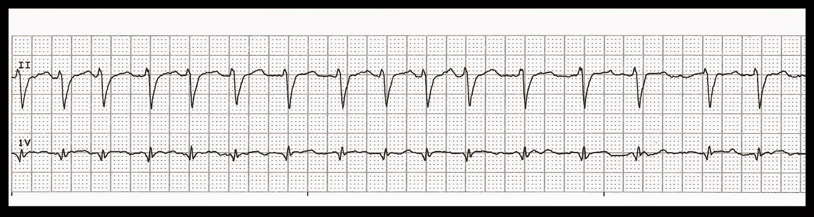 Practice EKG Strips 403