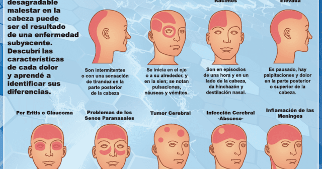 ¿Te duele la cabeza? Identifica el tipo de dolor