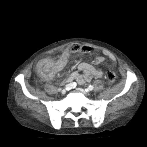 Buckeye Surgeon: Taxanes and Neutropenic Colitis