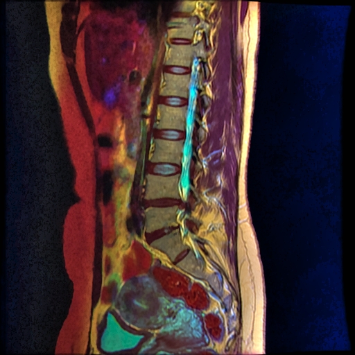 Nevit's blog: Color MRI of the Lumbar spine with extruded disc