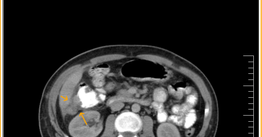 Appendicitis complicated with Subphrenic Abscess - Sumer's Radiology Blog