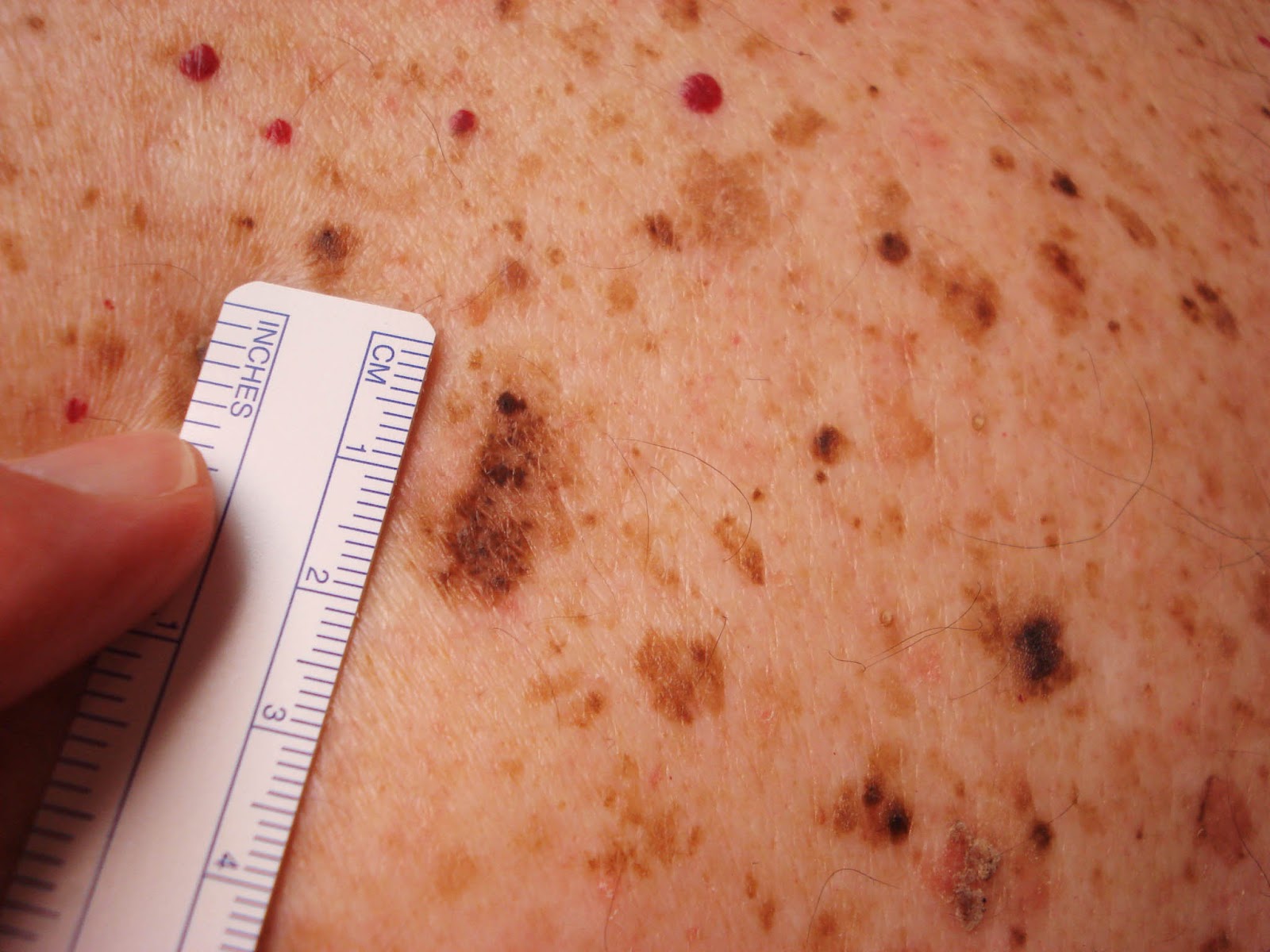 VIRTUAL GRAND ROUNDS IN DERMATOLOGY 2.0: Atypical Melanocytic Lesions